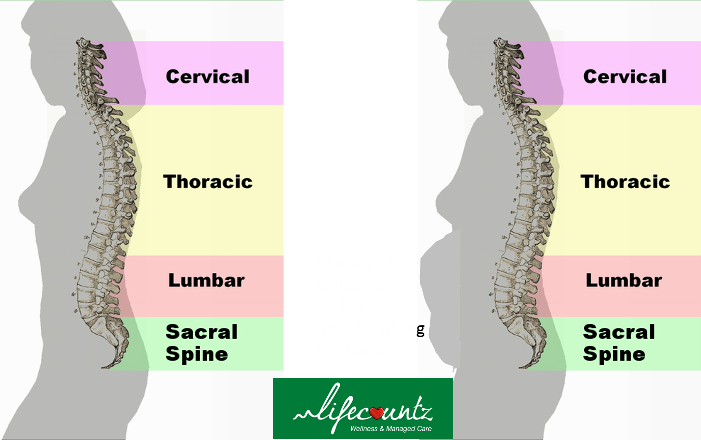 Obesity and Backache by Dr Asmita Shah
